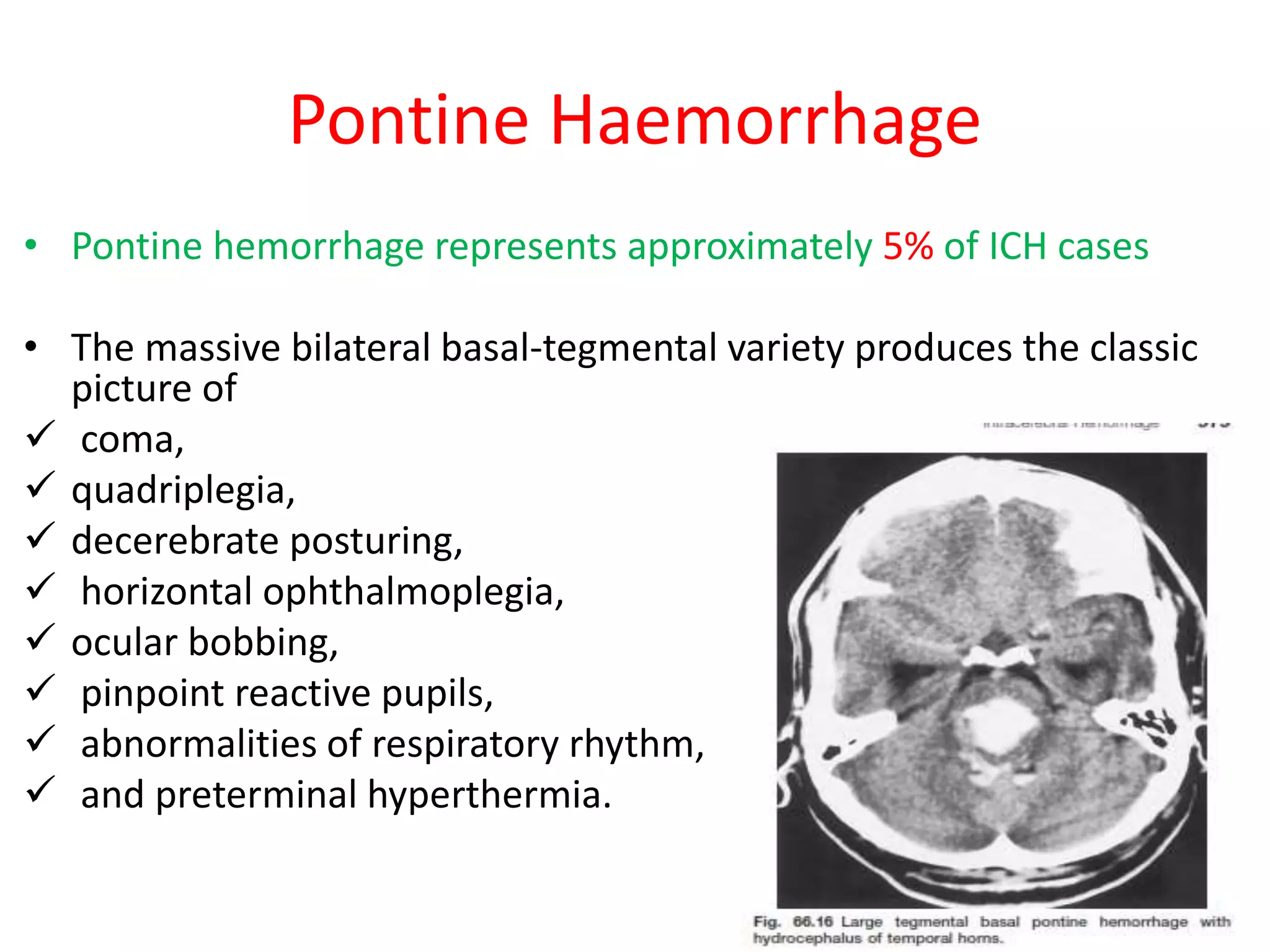 Pons anatomy and syndromes | PPTX