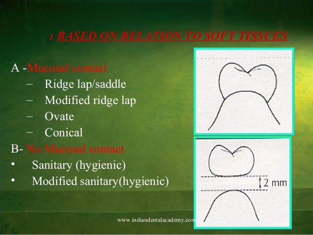 Pontic/ orthodontic straight wire technique