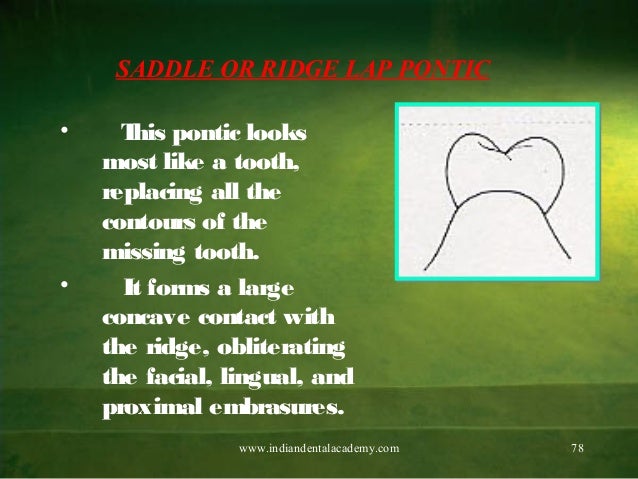 Pontic/ orthodontic straight wire technique