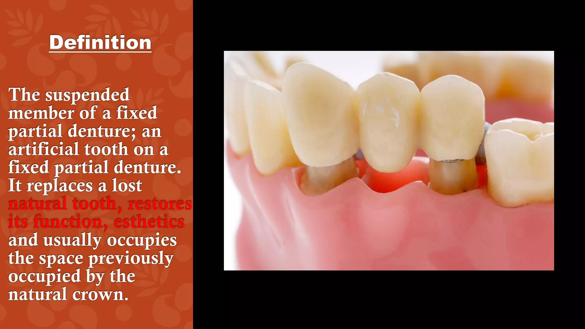 Pontic fixed prosthodontics | PDF