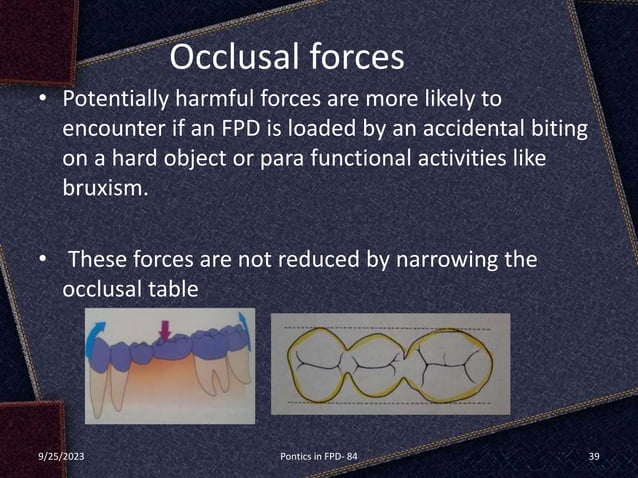 pontic in fpd | PPTX