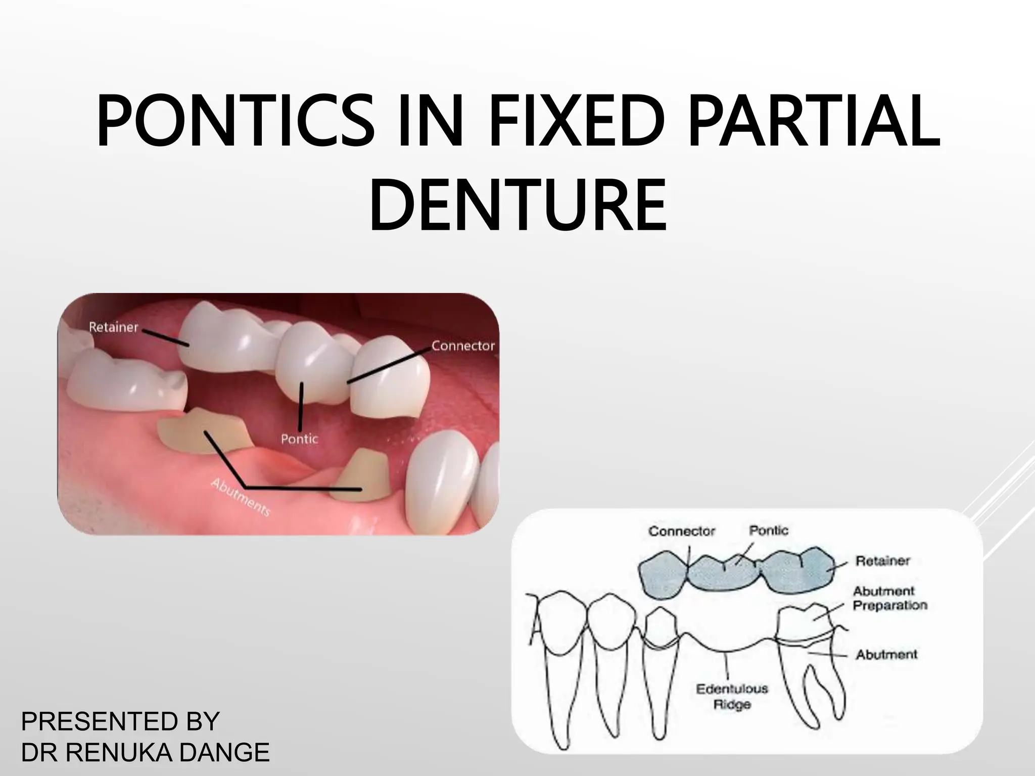 PONTICS IN FIXED PARTIAL DENTURE FOR ORAL | PPT