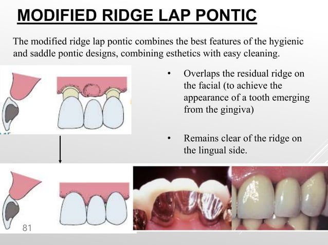 PONTICS IN FIXED PARTIAL DENTURE FOR ORAL | PPT