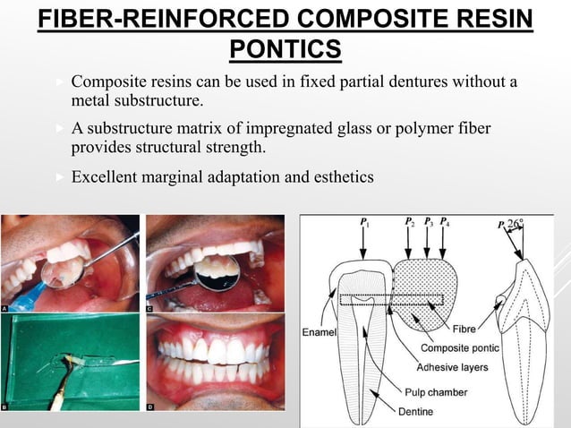 PONTICS IN FIXED PARTIAL DENTURE FOR ORAL | PPT