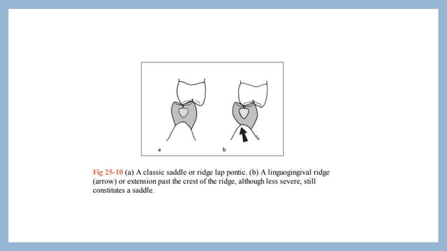 pontic in making teeth for dental practices | PPTX