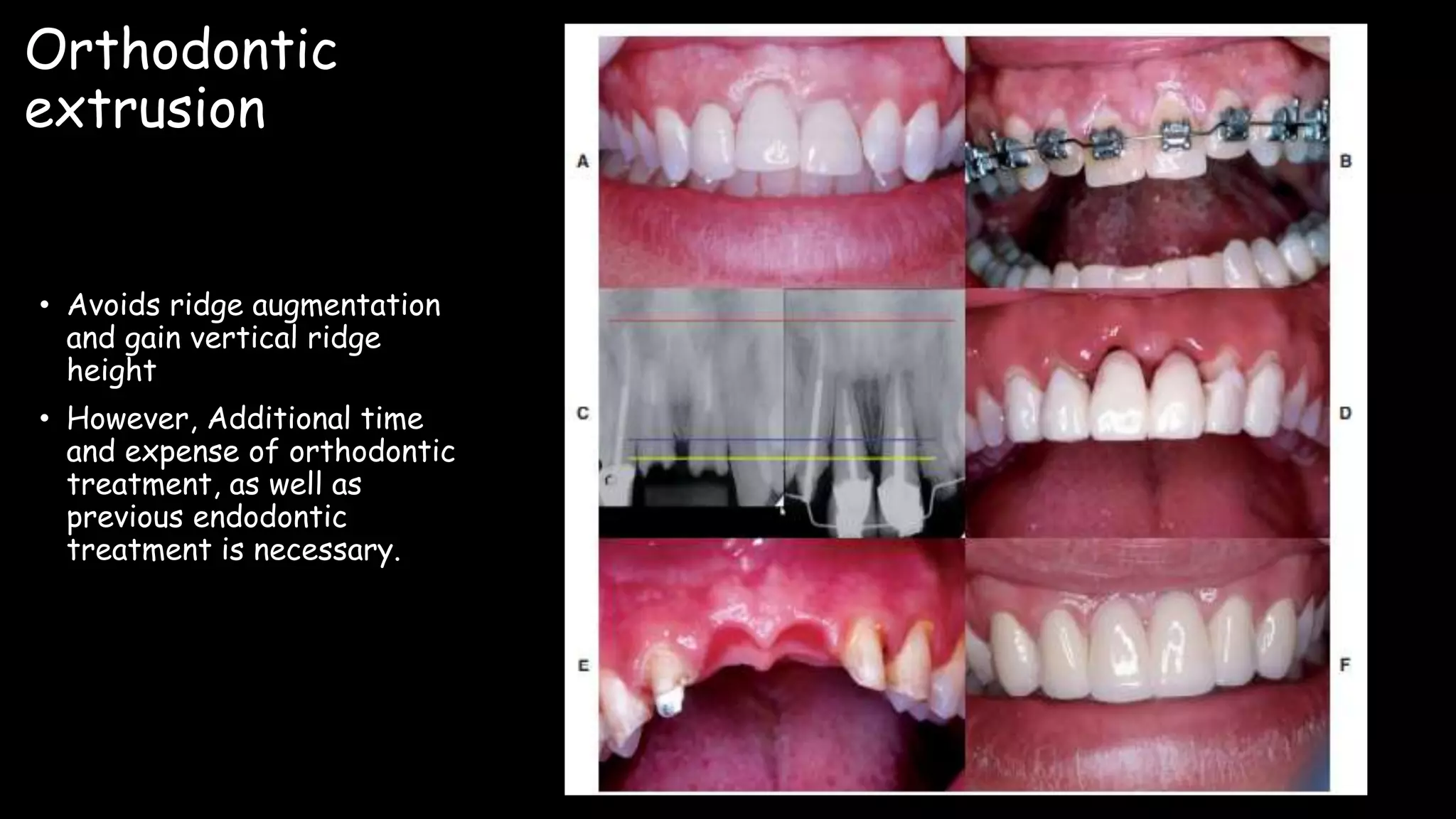 Pontic and pontic designs | PPTX