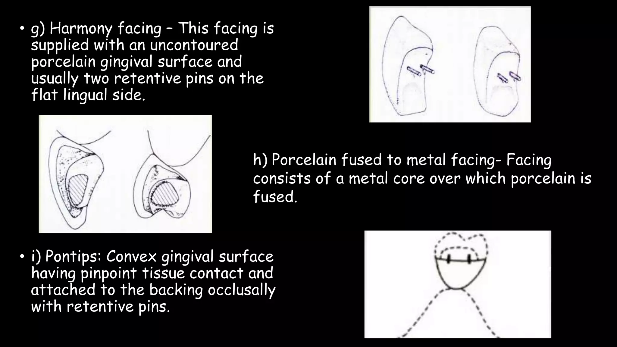 Pontic and pontic designs | PPTX