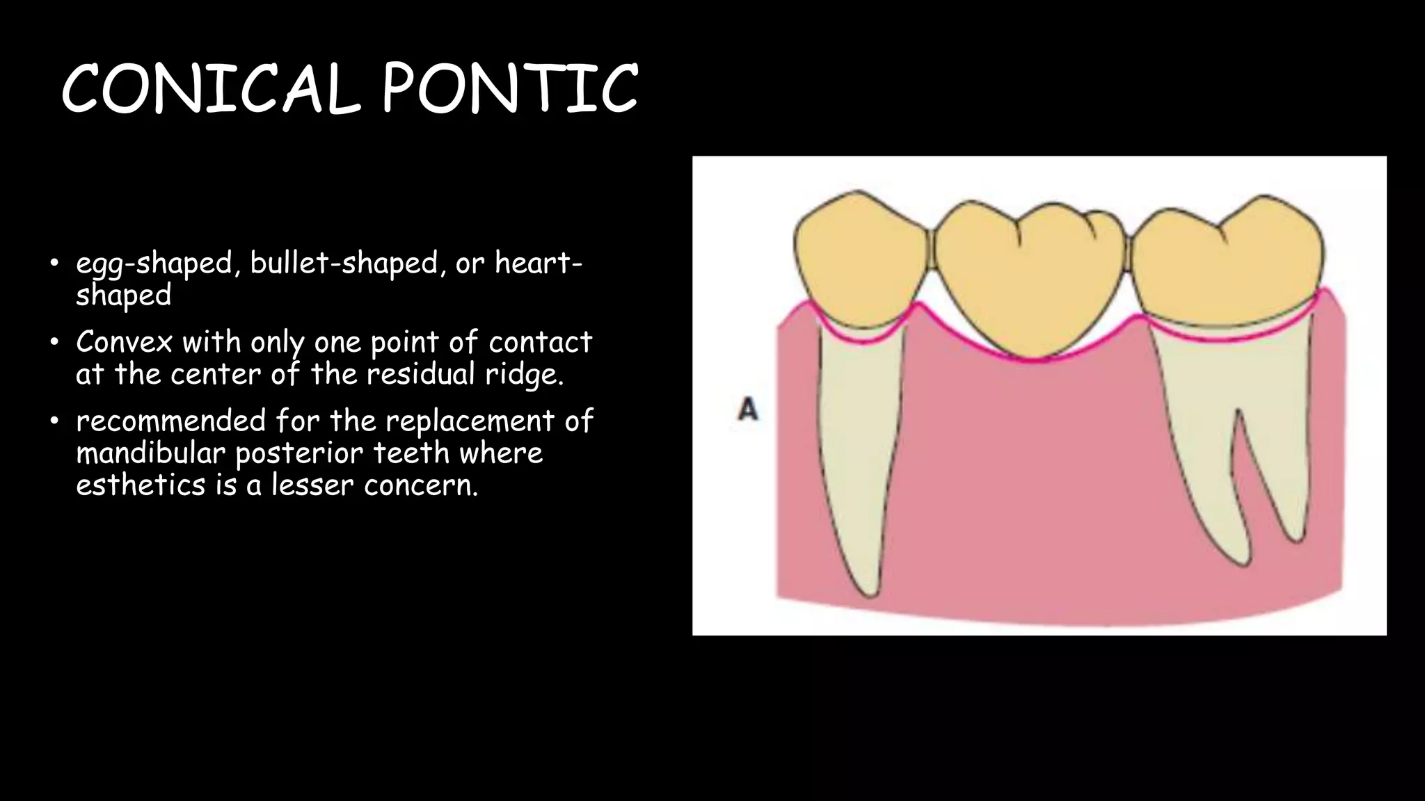 Pontic and pontic designs | PPTX