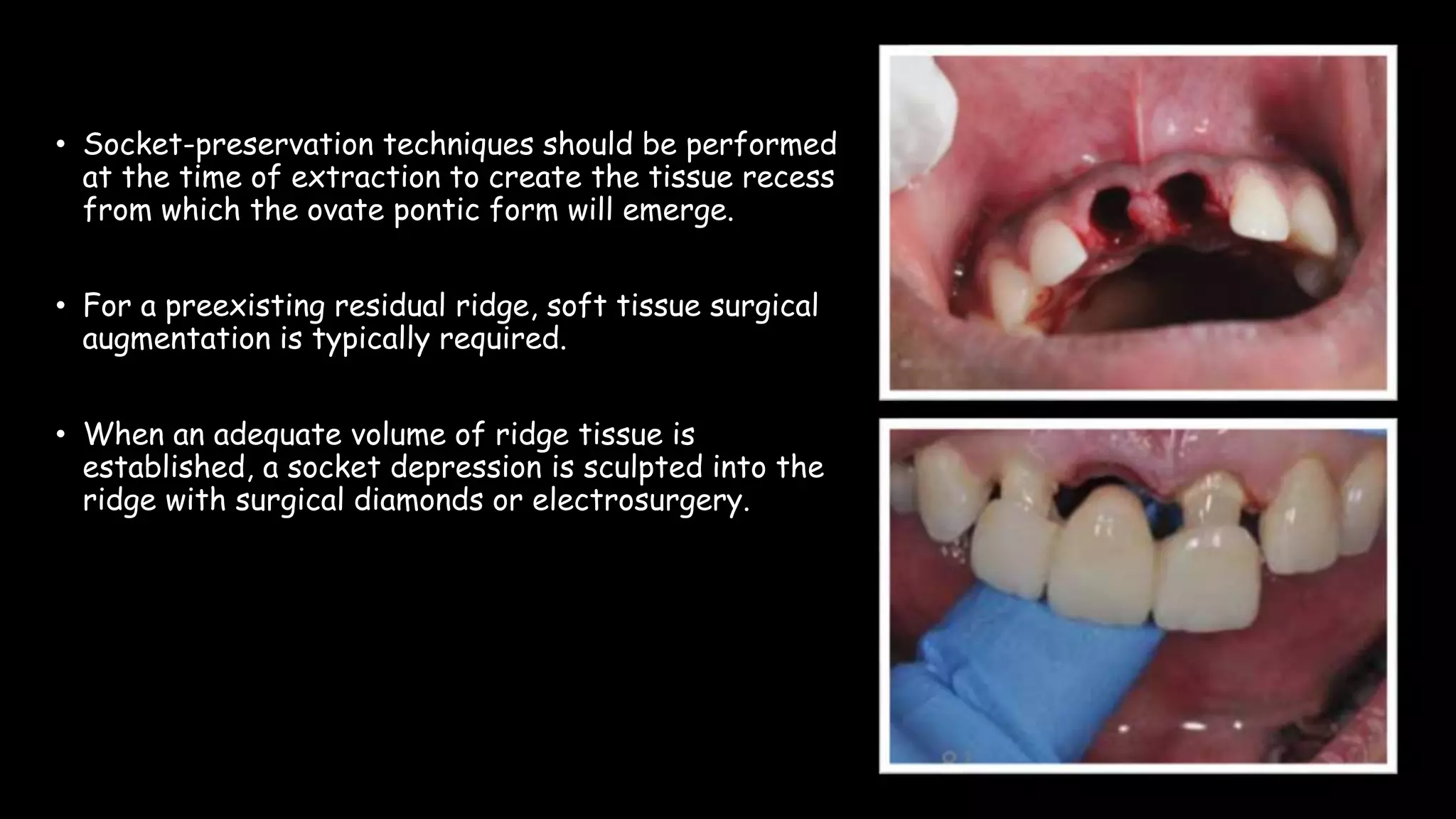 Pontic and pontic designs | PPTX