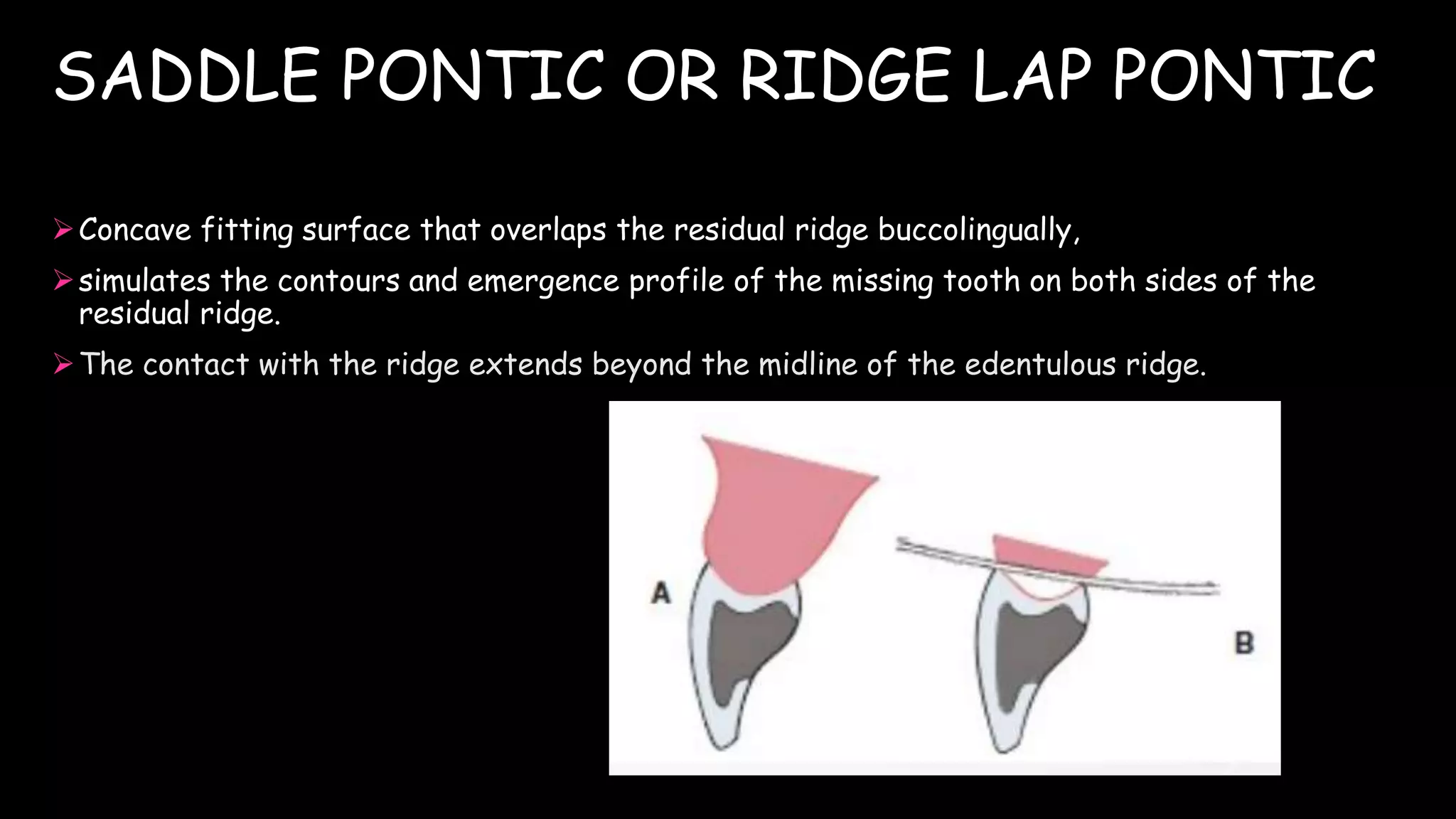 Pontic and pontic designs | PPTX