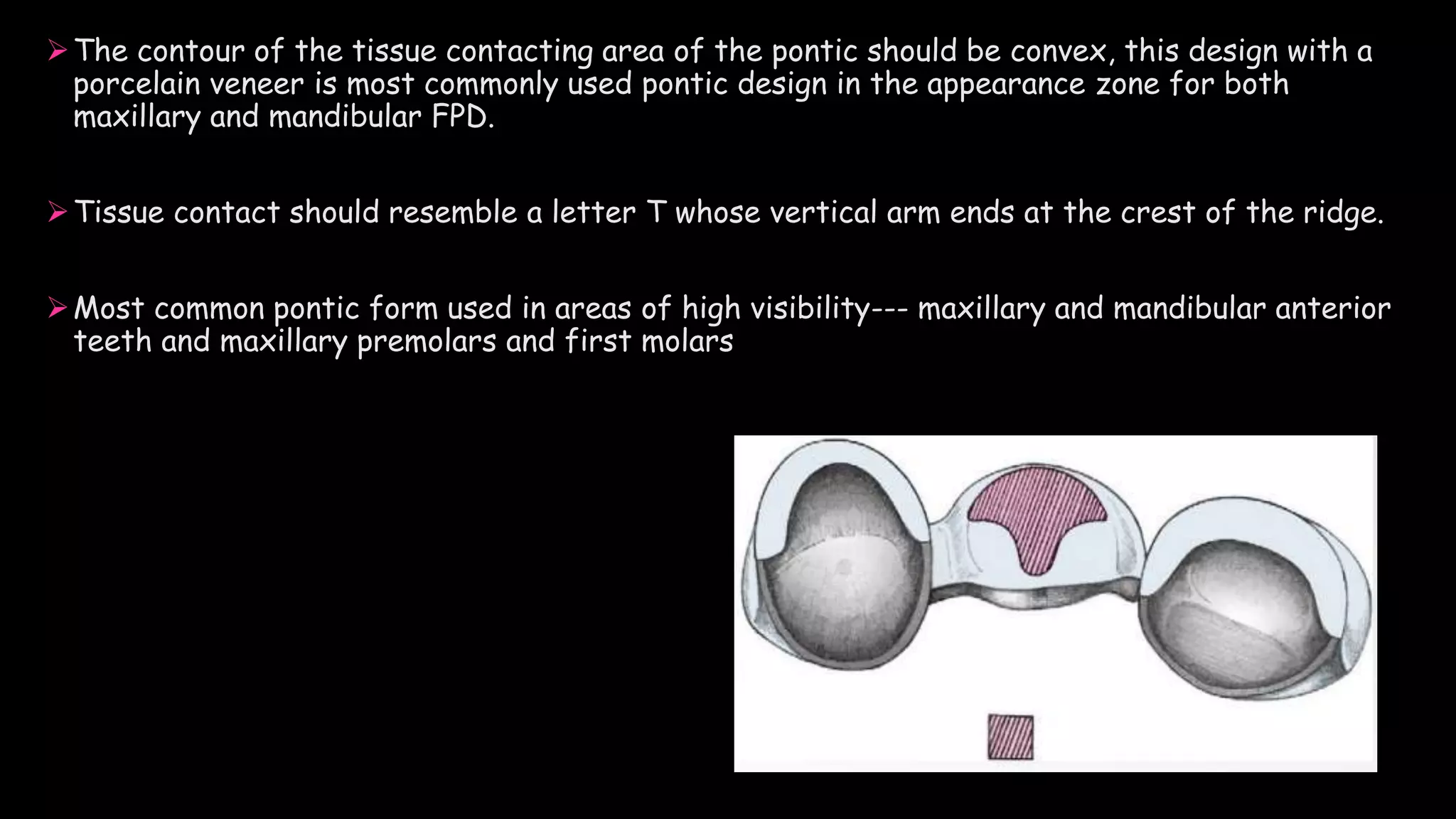 Pontic and pontic designs | PPTX