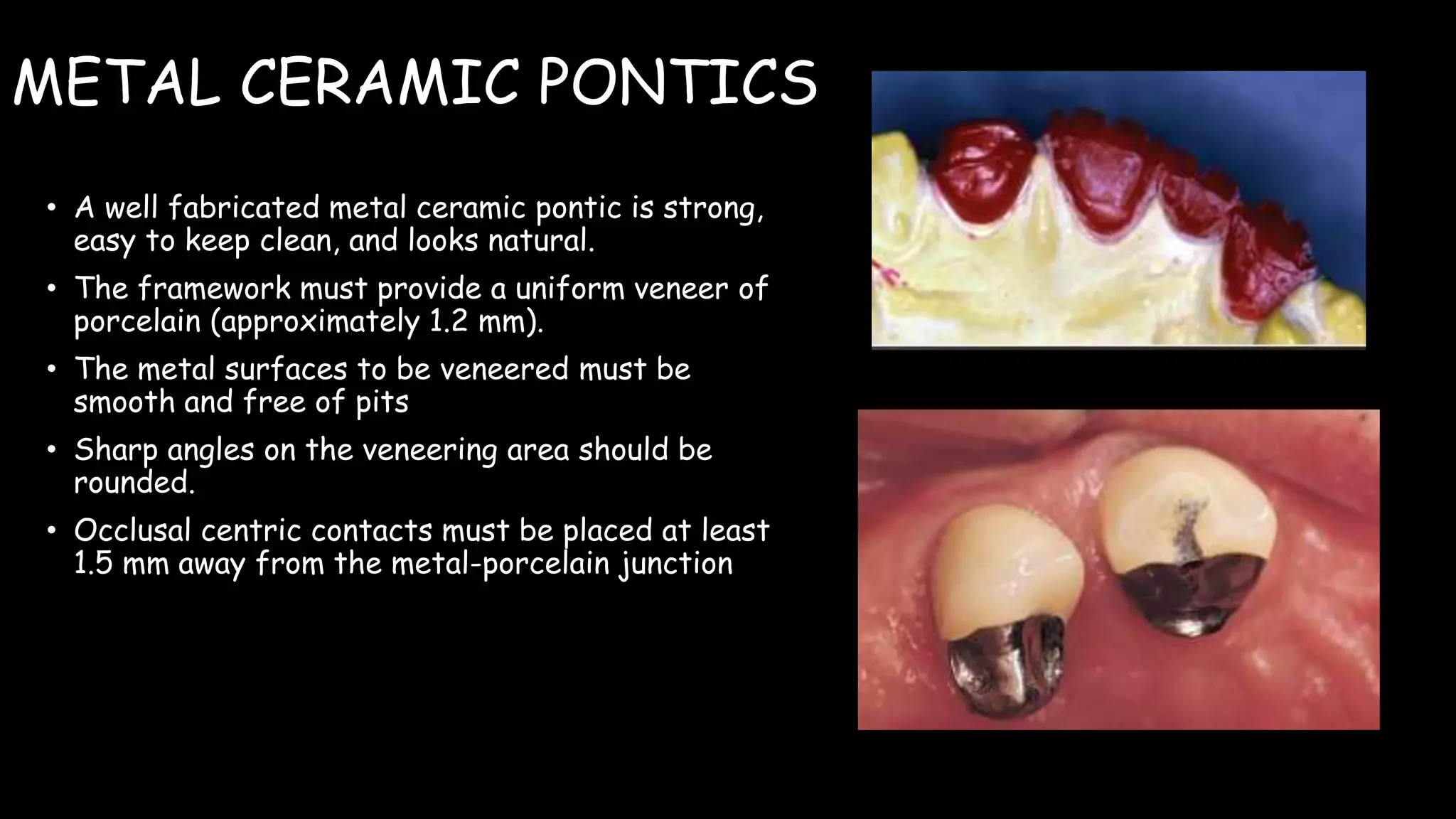 Pontic and pontic designs | PPTX