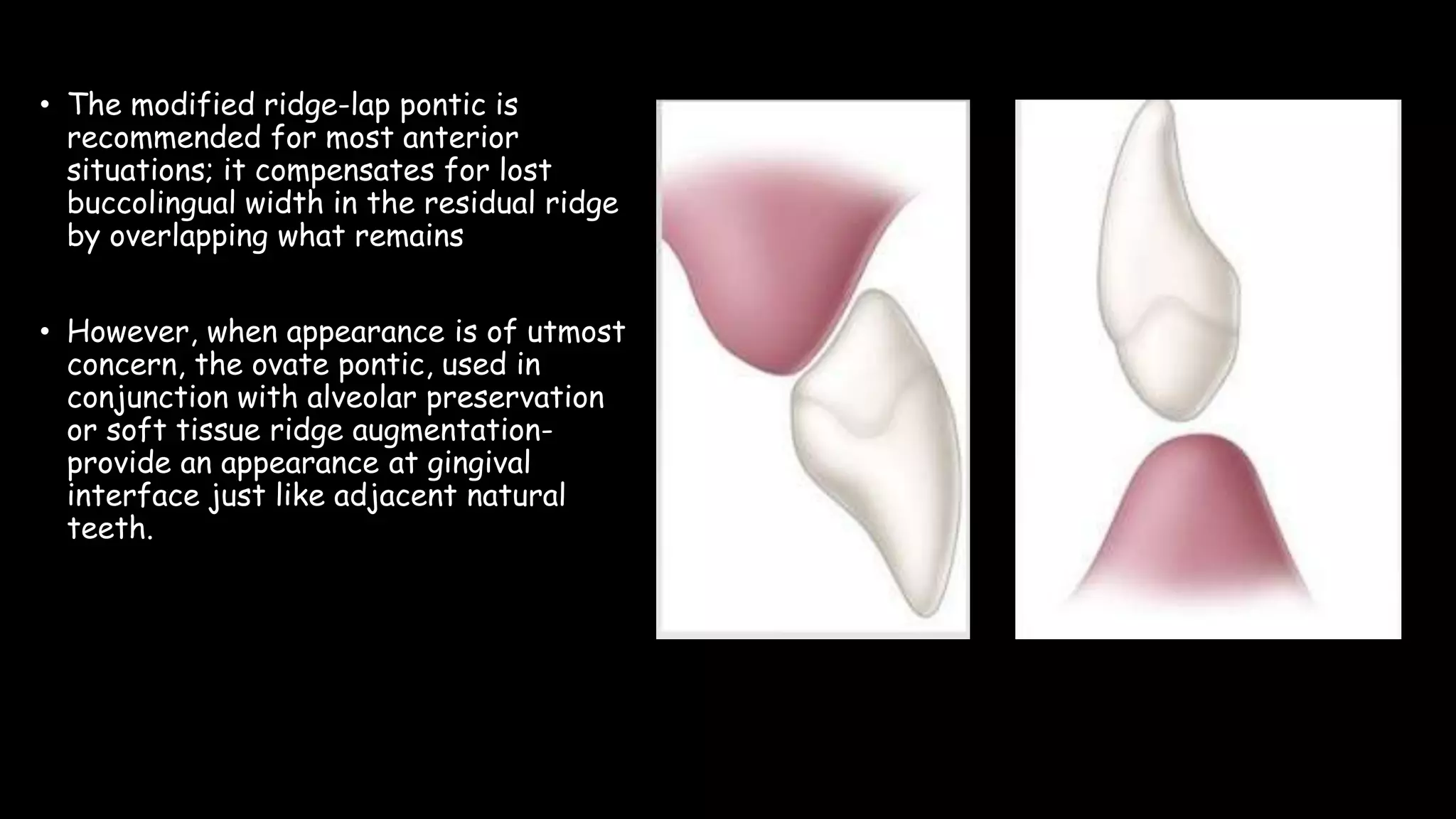 Pontic and pontic designs | PPTX