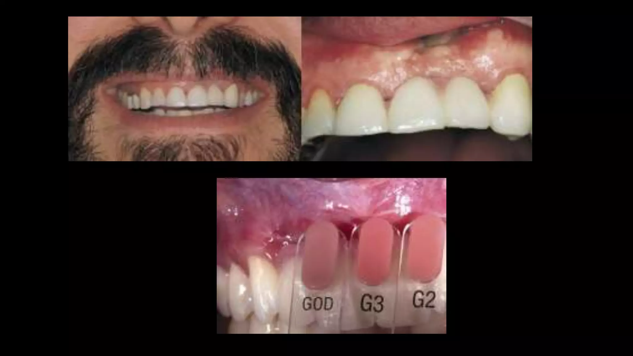 Pontic and pontic designs | PPTX