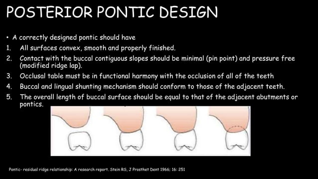 Pontic and pontic designs | PPTX | Oral care | Personal Care