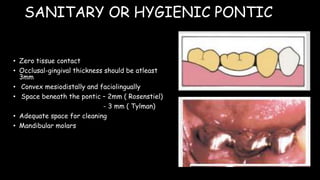 Pontic and pontic designs | PPTX