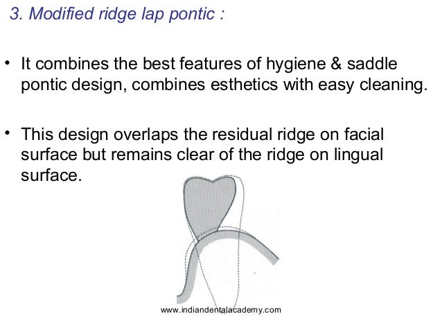 Pontic design / orthodontic straight wire technique