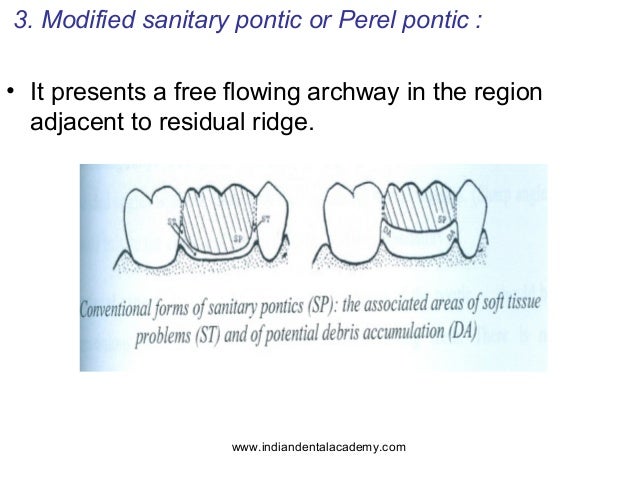 Pontic design / orthodontic straight wire technique
