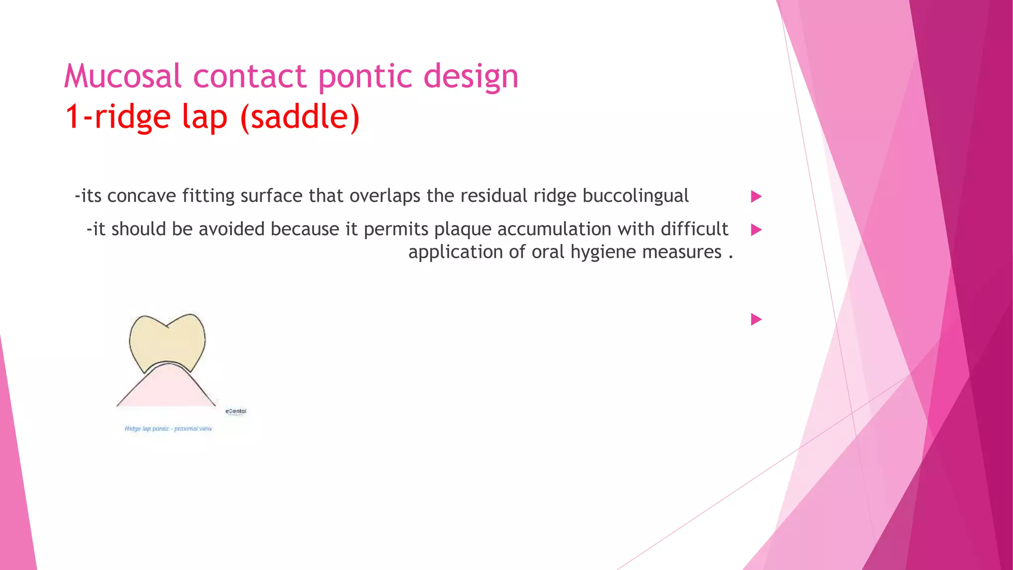 Pontic design and finish line.pptx