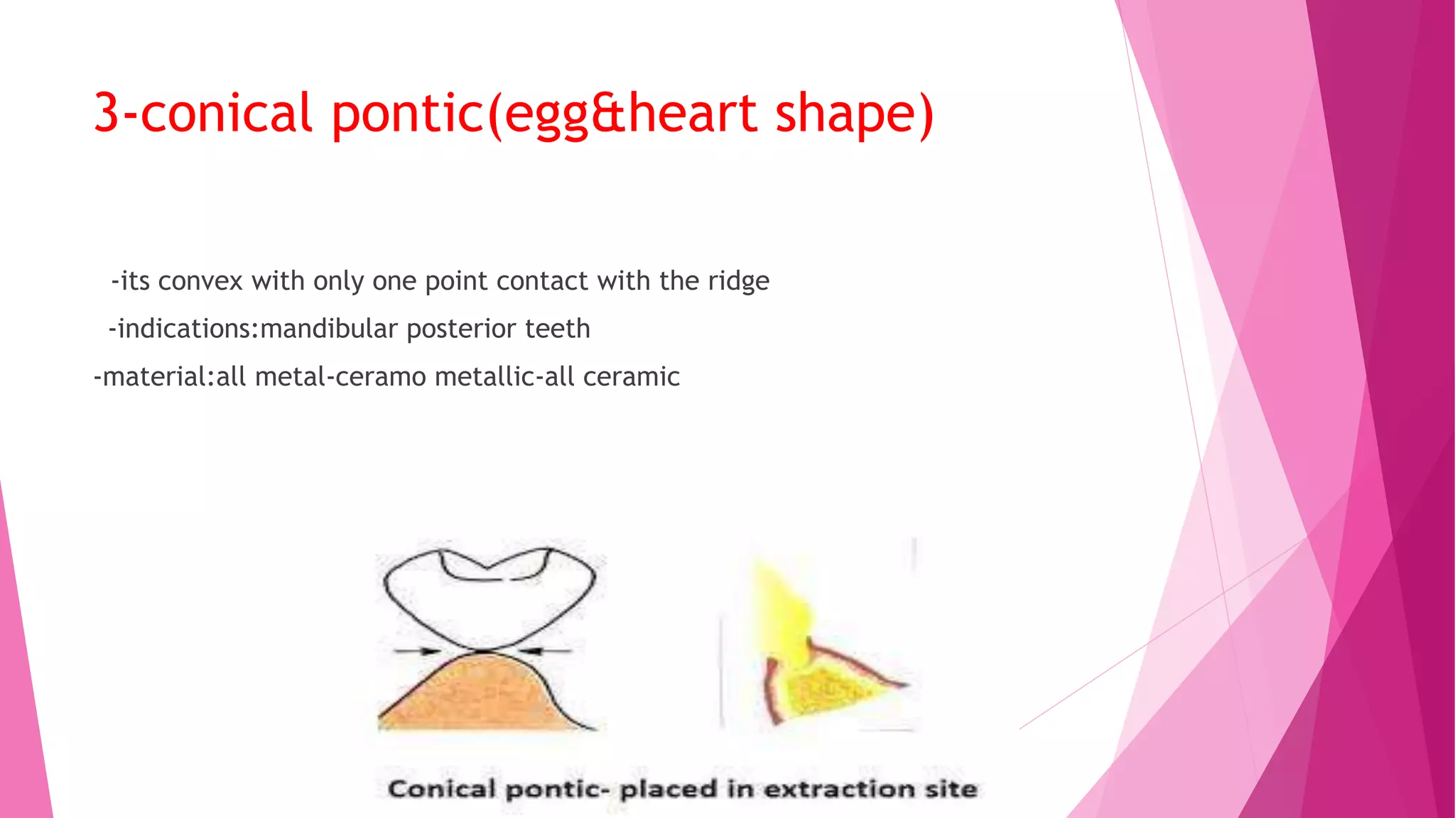 Pontic design and finish line.pptx