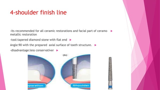 Pontic design and finish line.pptx