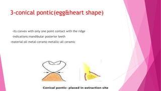 Pontic design and finish line.pptx