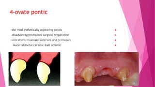 Pontic design and finish line.pptx