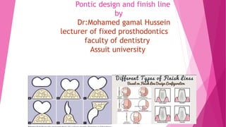 Pontic Design and Finish Line Types | PPT