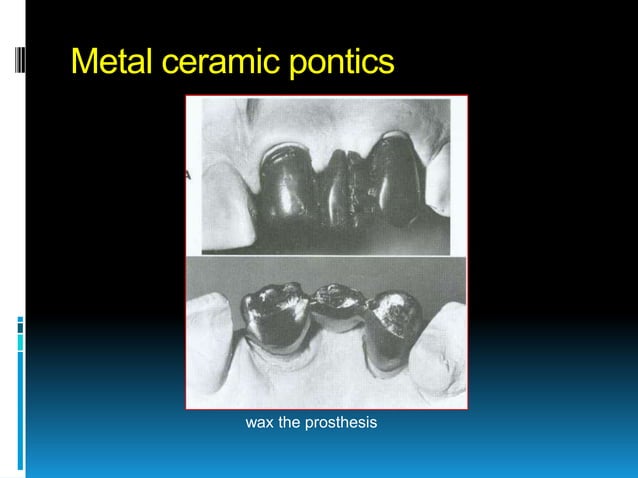 Pontics | PPTX