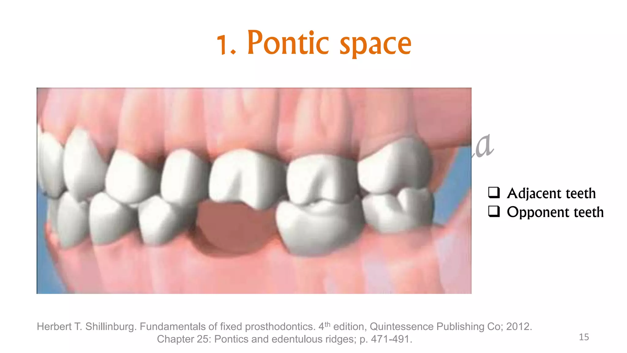 Pontics | PPTX