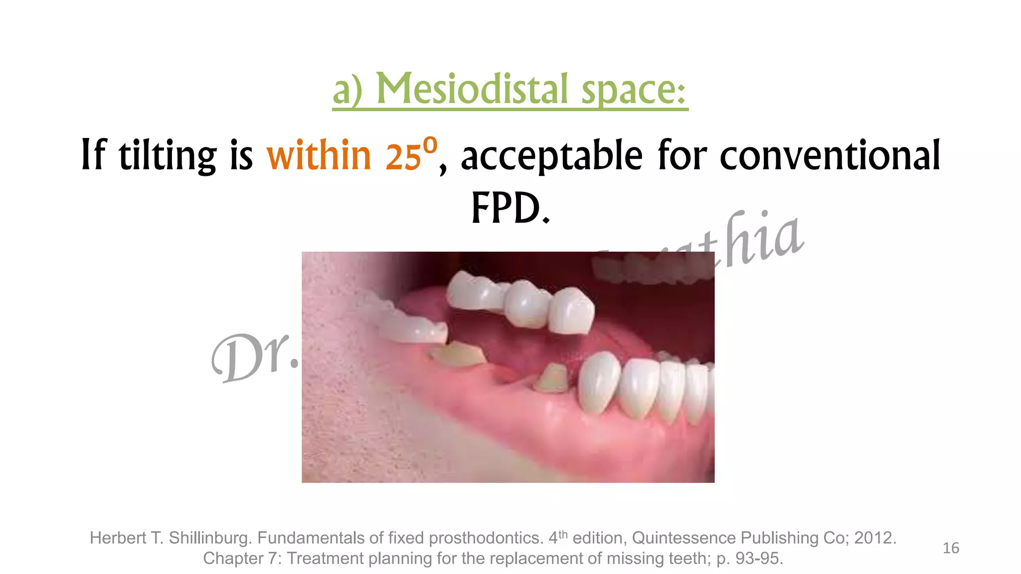 Pontics | PPTX