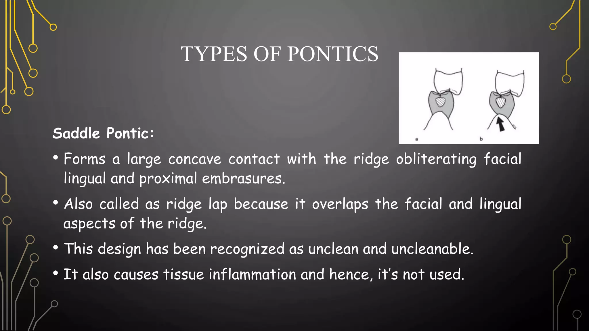 Pontics in Fixed Partial Denture | PPTX