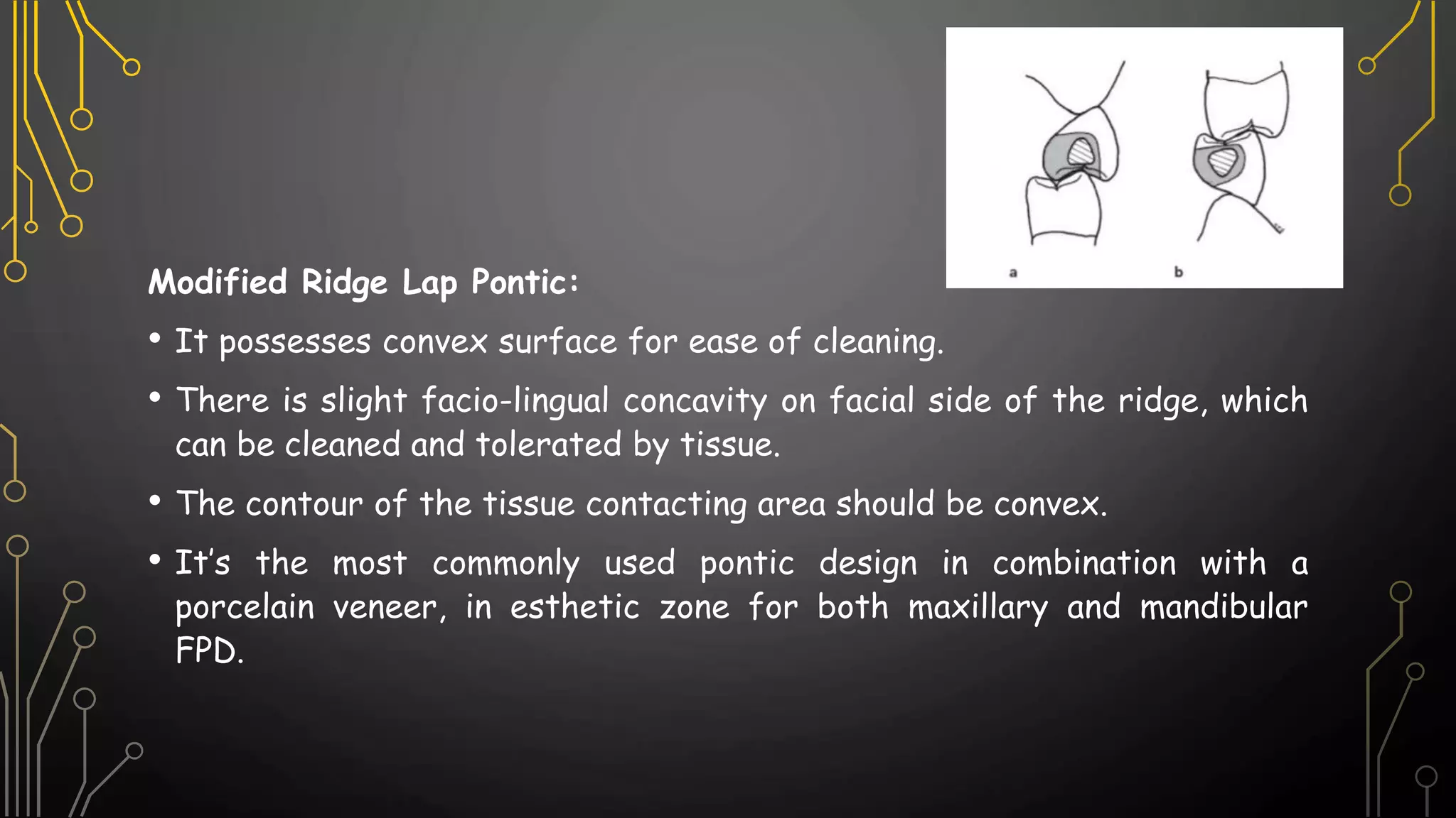 Pontics in Fixed Partial Denture | PPTX