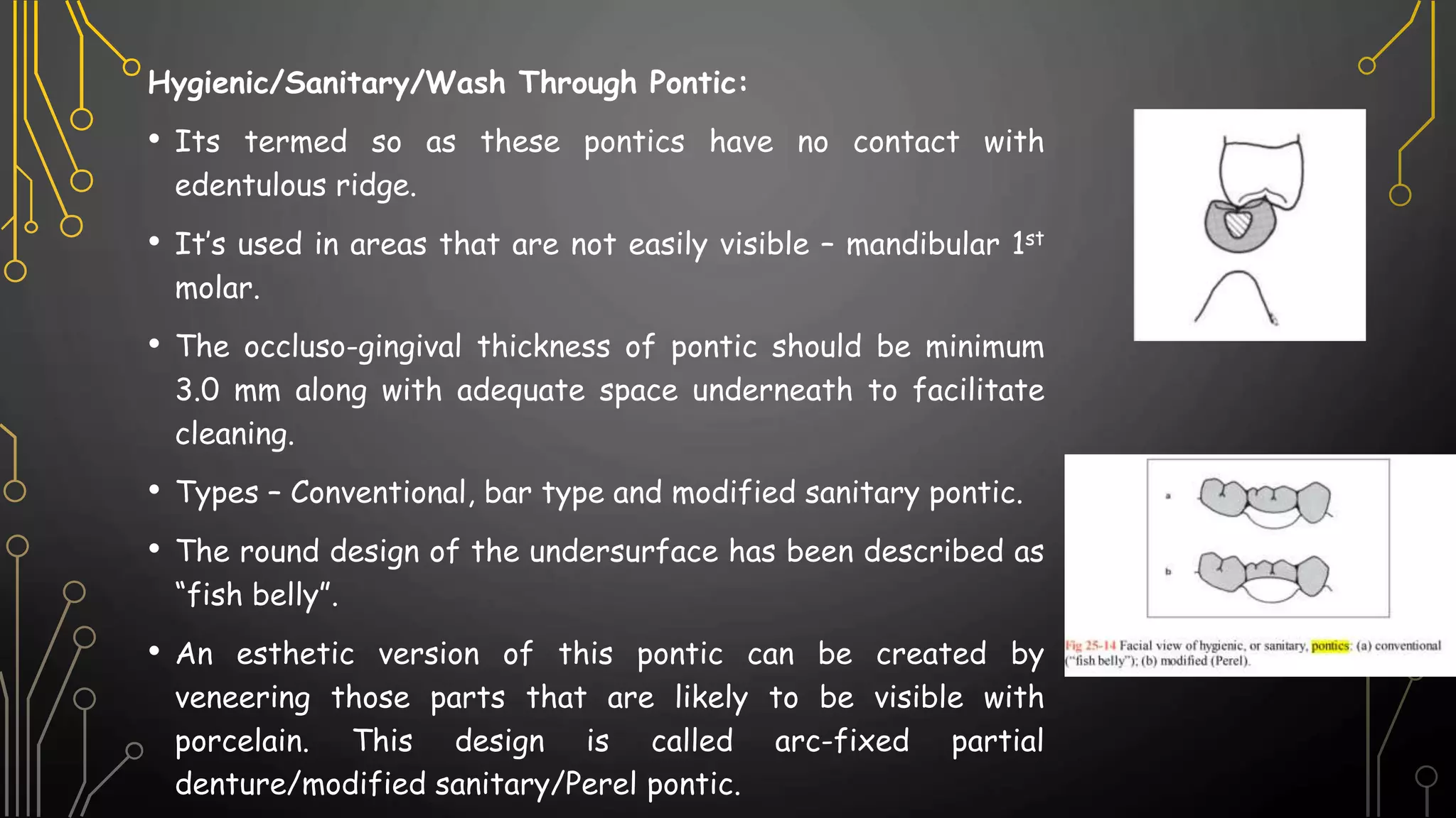 Pontics in Fixed Partial Denture | PPTX