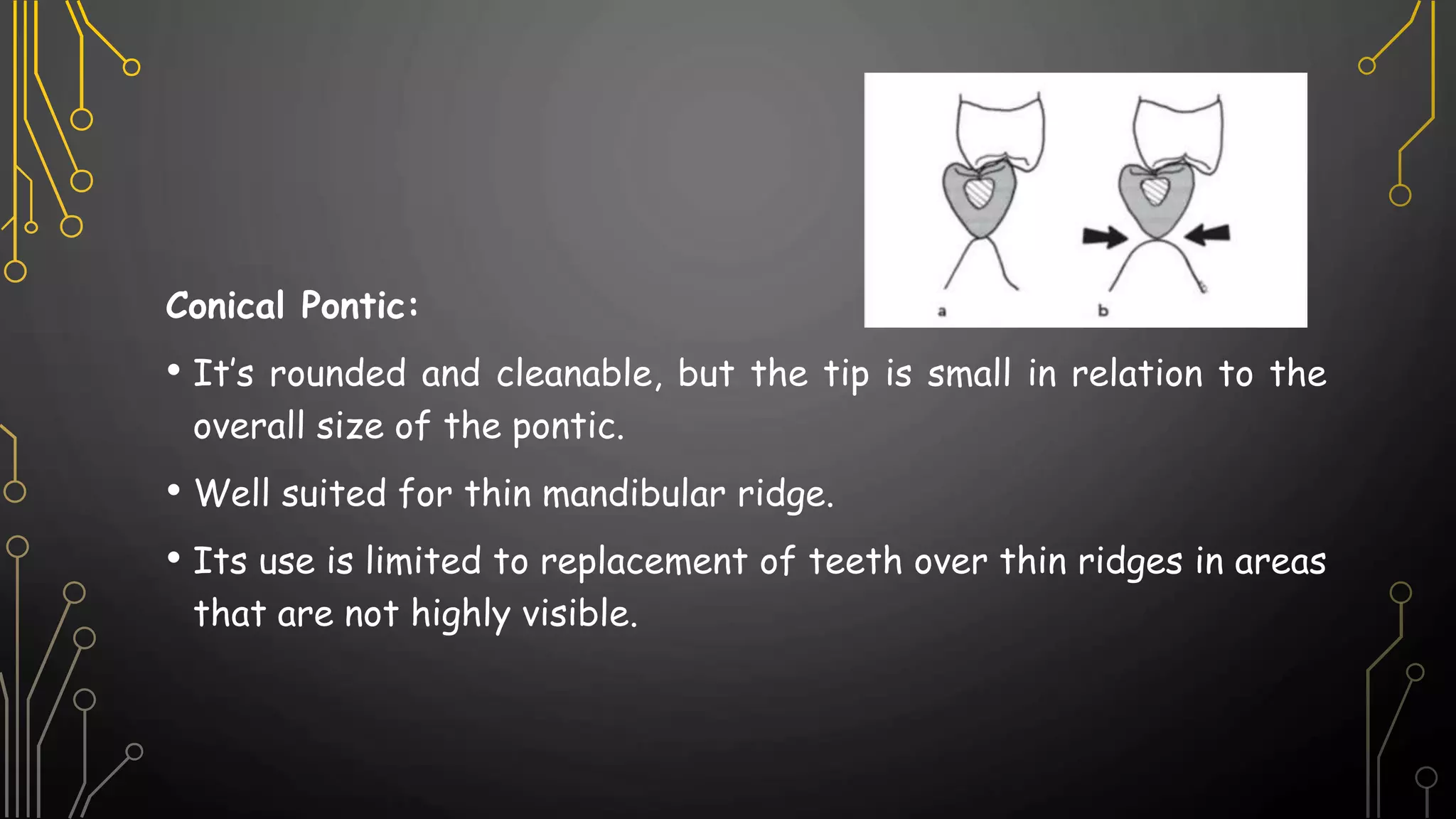 Pontics in Fixed Partial Denture | PPTX