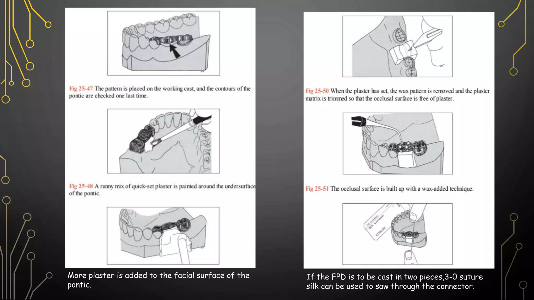 Pontics in Fixed Partial Denture | PPTX