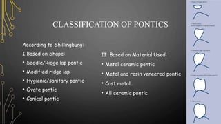 Pontics in Fixed Partial Denture | PPTX