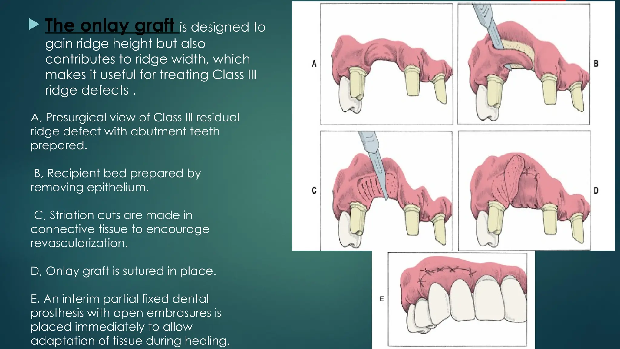 It is of topic PONTICS in fixed partial deture.pptx