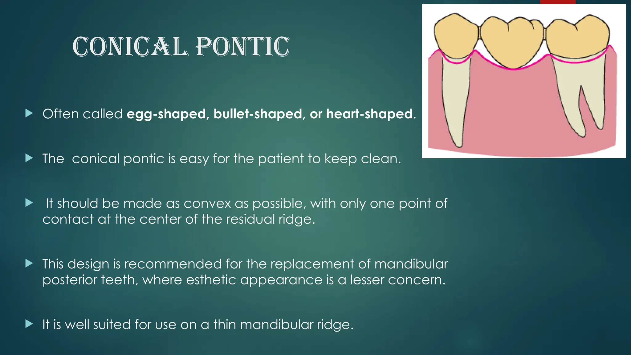 It is of topic PONTICS in fixed partial deture.pptx