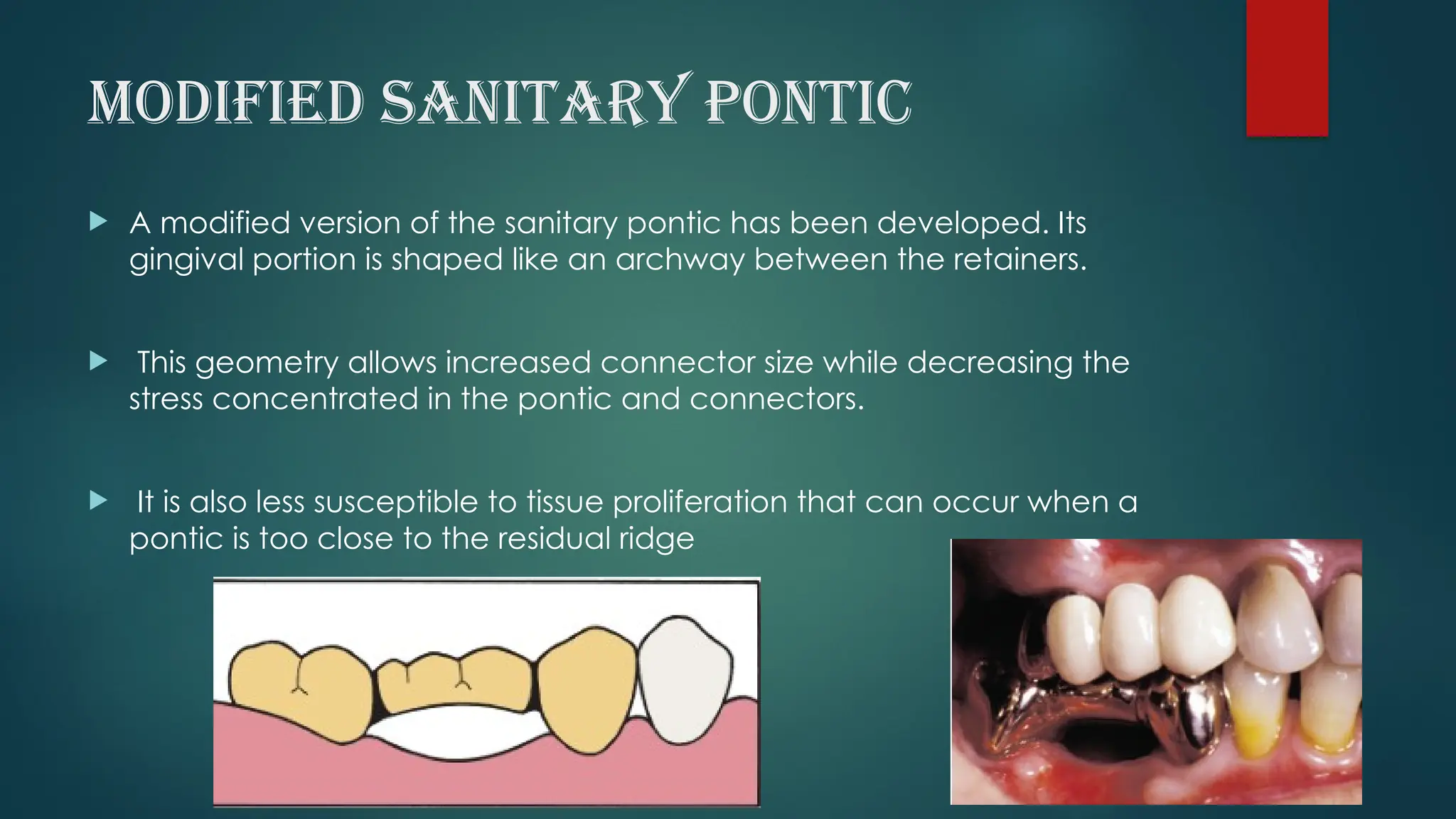 It is of topic PONTICS in fixed partial deture.pptx