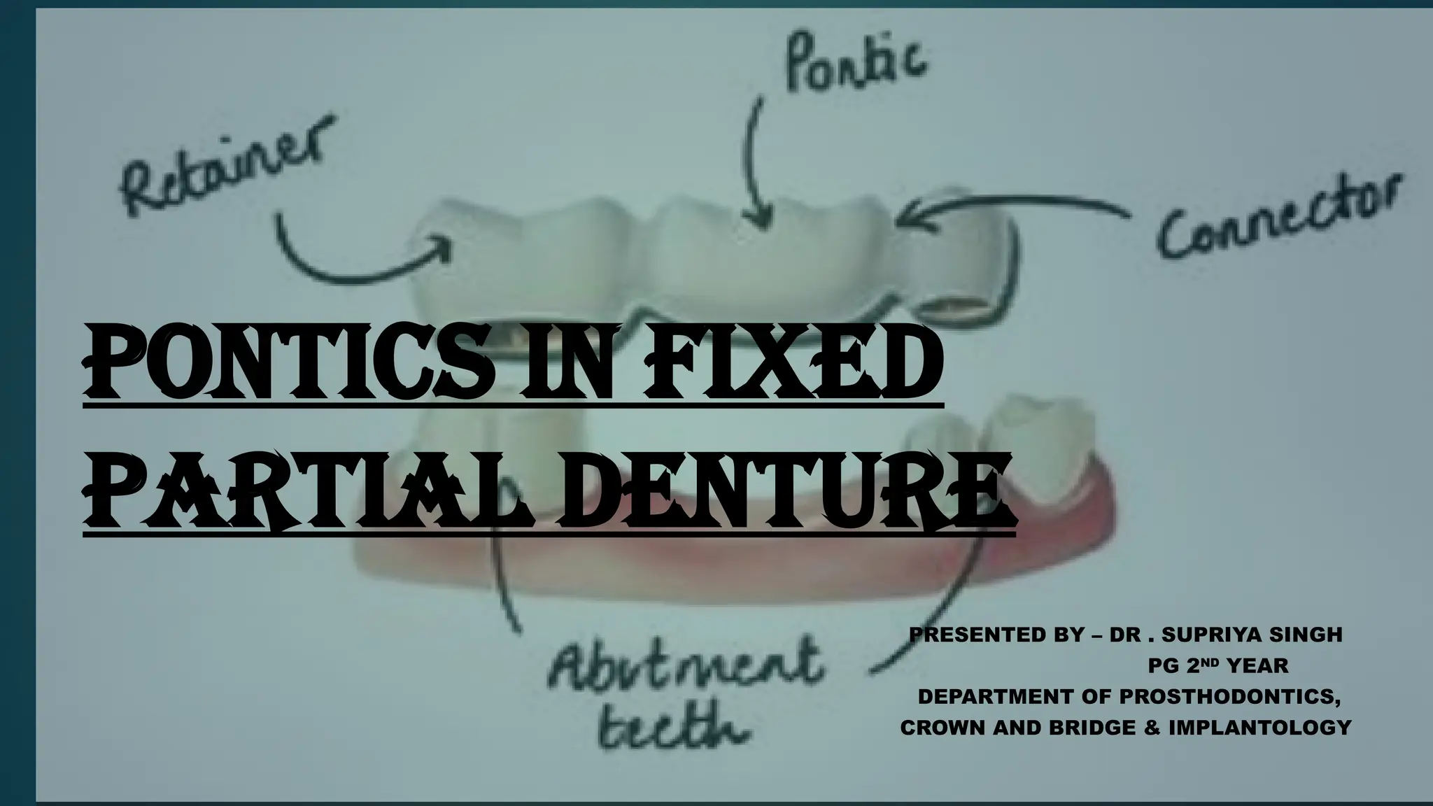 PONTICS as a part of fixed partial denture | PPTX