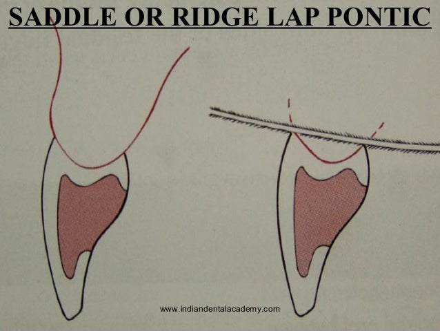 Pontics /certified fixed orthodontic courses by Indian dental academ…
