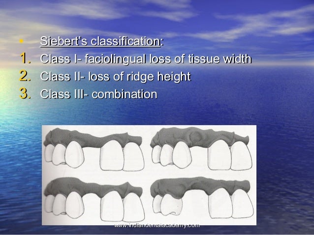 Pontics 1/endodontic courses