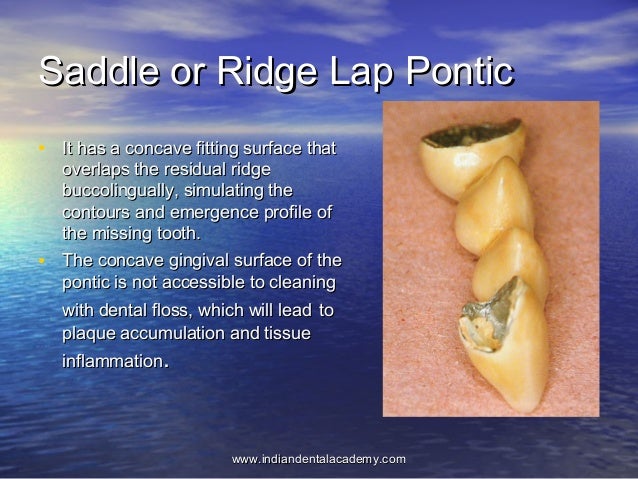 Pontics 1/endodontic courses