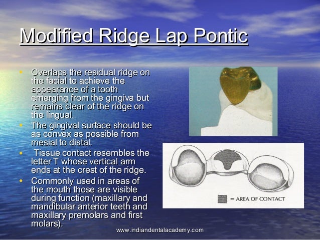 Pontics 1/endodontic courses