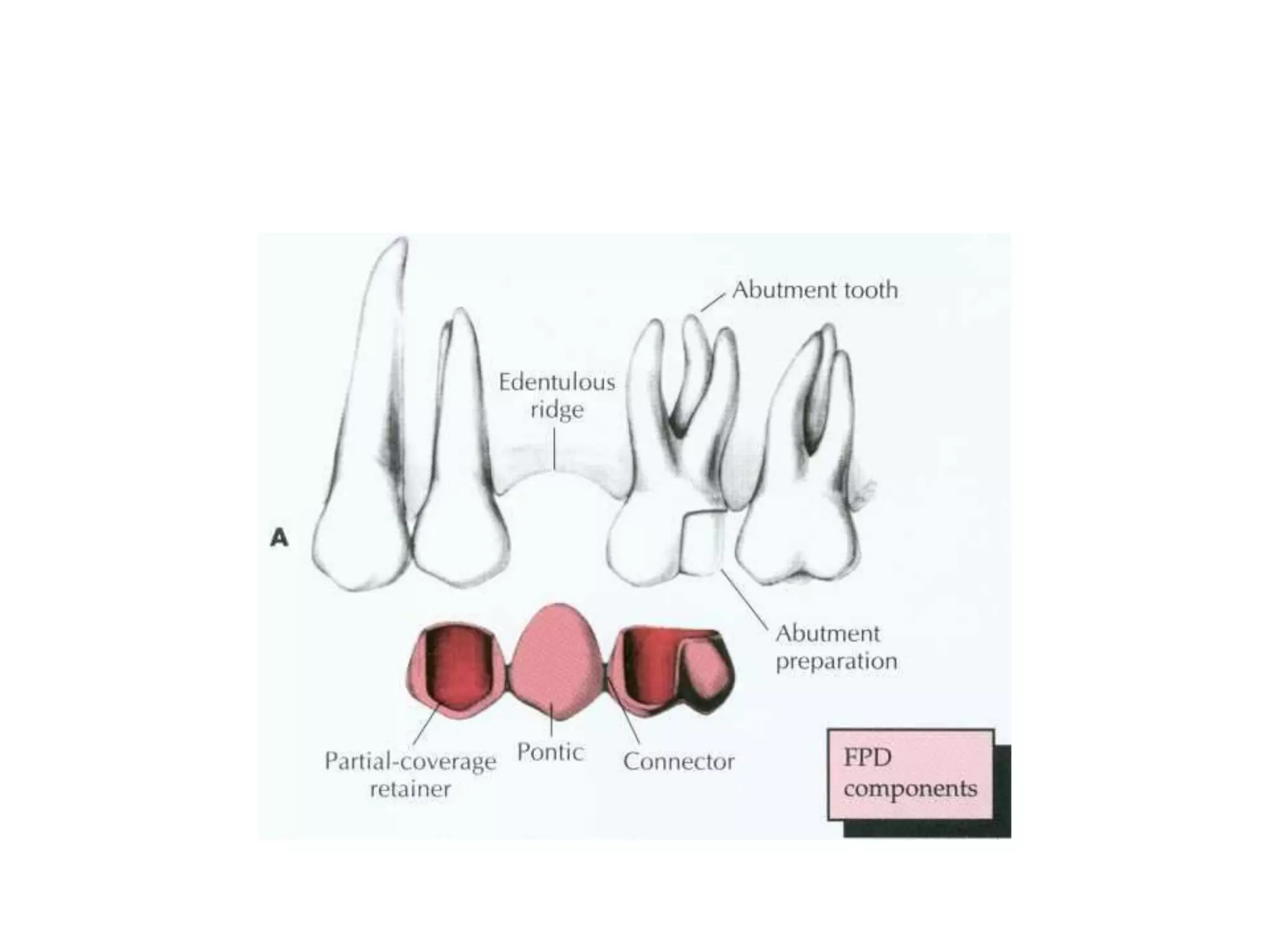 Pontics and Retainers | PPTX