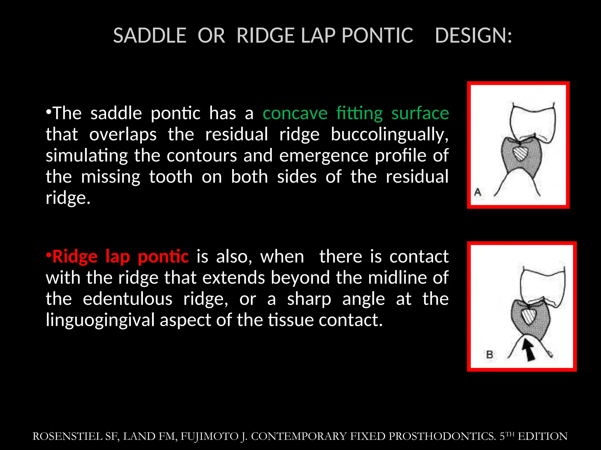 pontic selection in FPD.ppttg5tv4rccccwedxqq | PPT