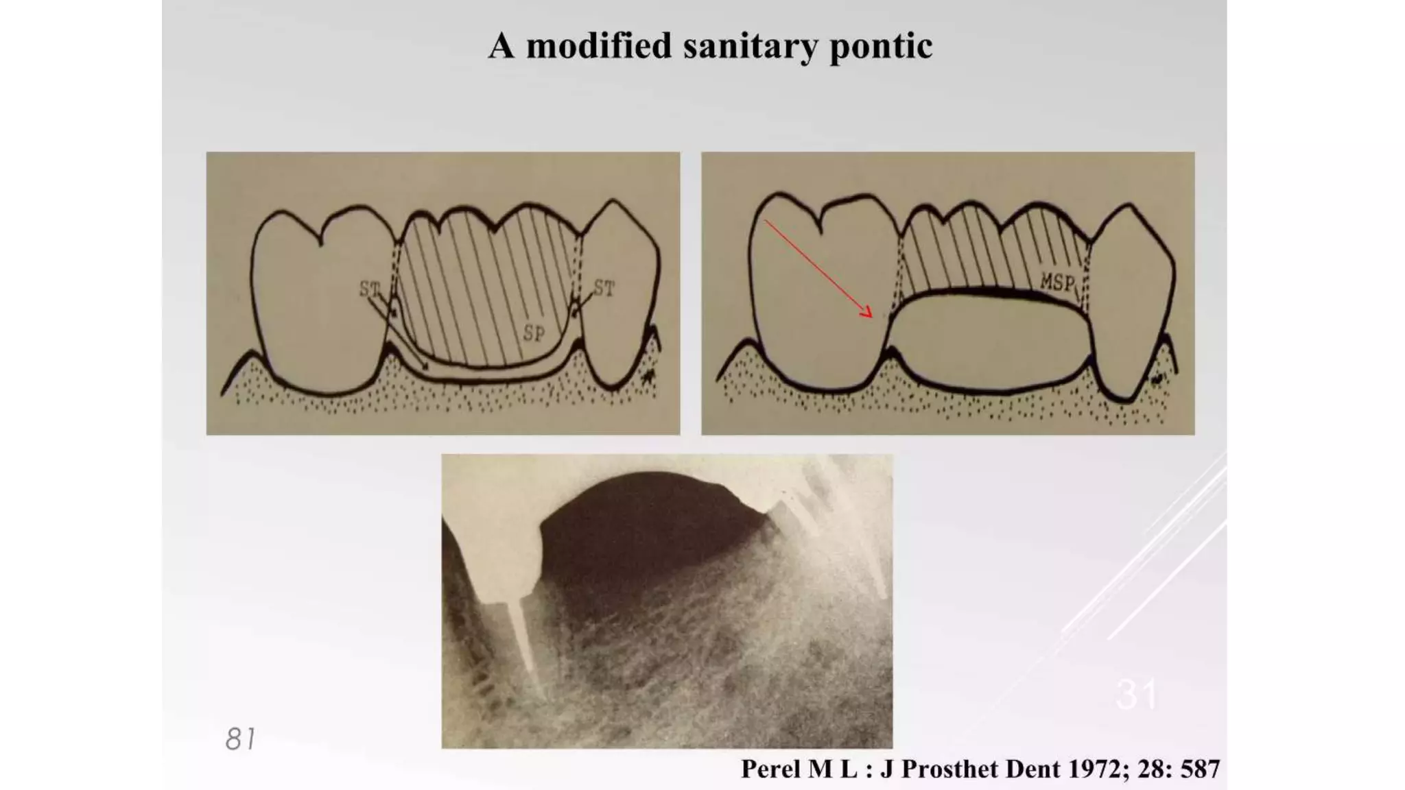 PONTICS IN FIXED PARTIAL DENTURE.pptx