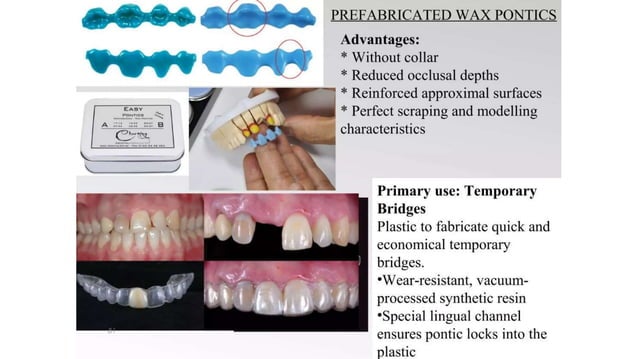 PONTICS IN FIXED PARTIAL DENTURE.pptx