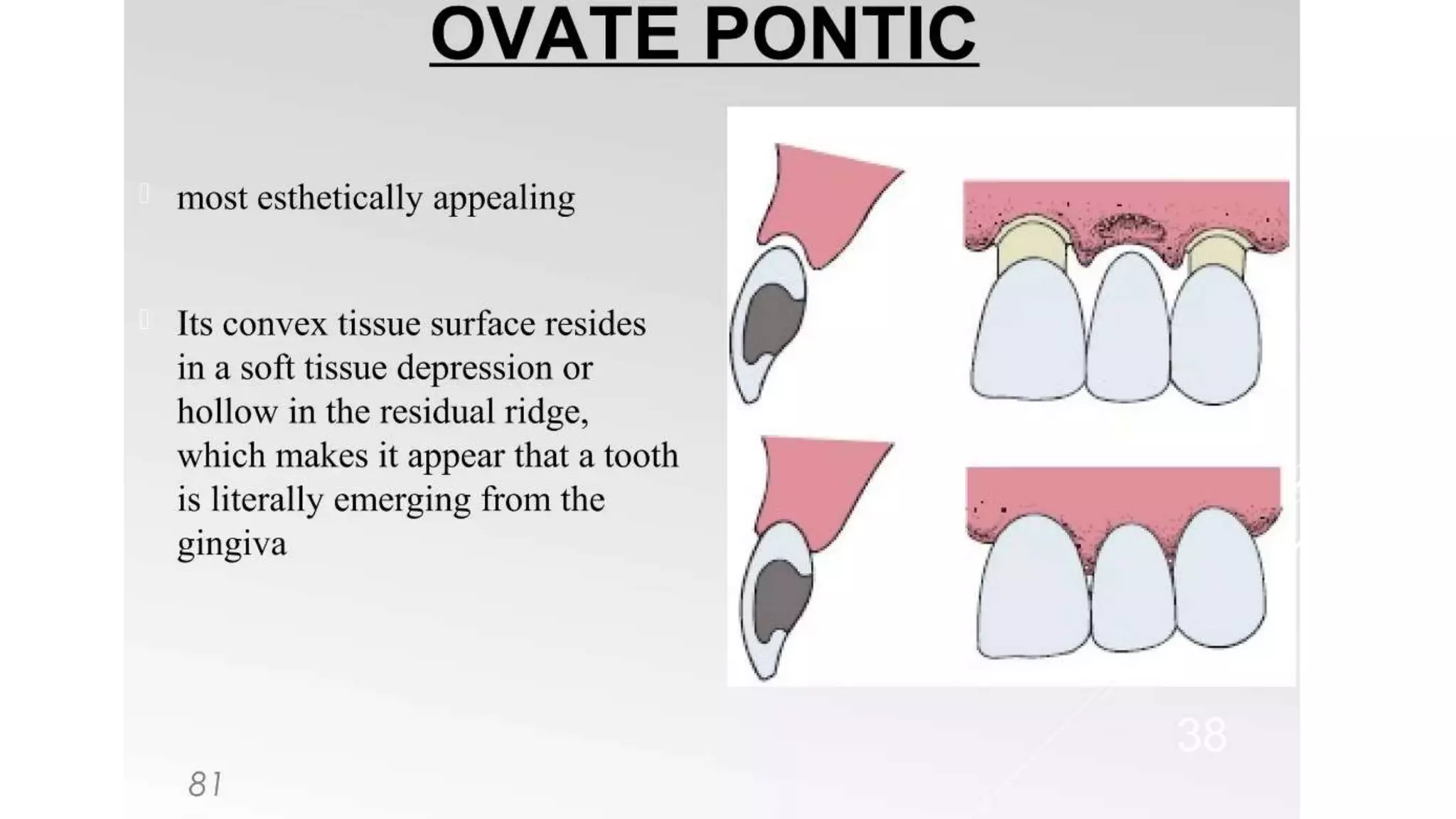 PONTICS IN FIXED PARTIAL DENTURE.pptx